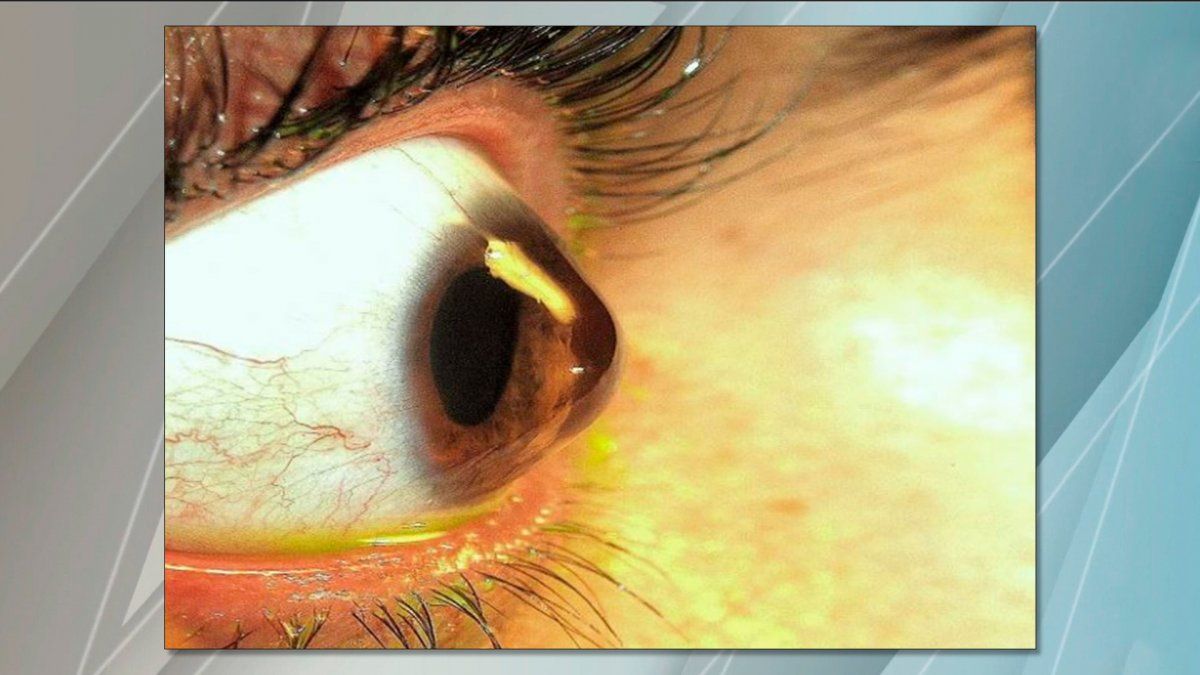 Problemas oculares en las personas con Síndrome de Down